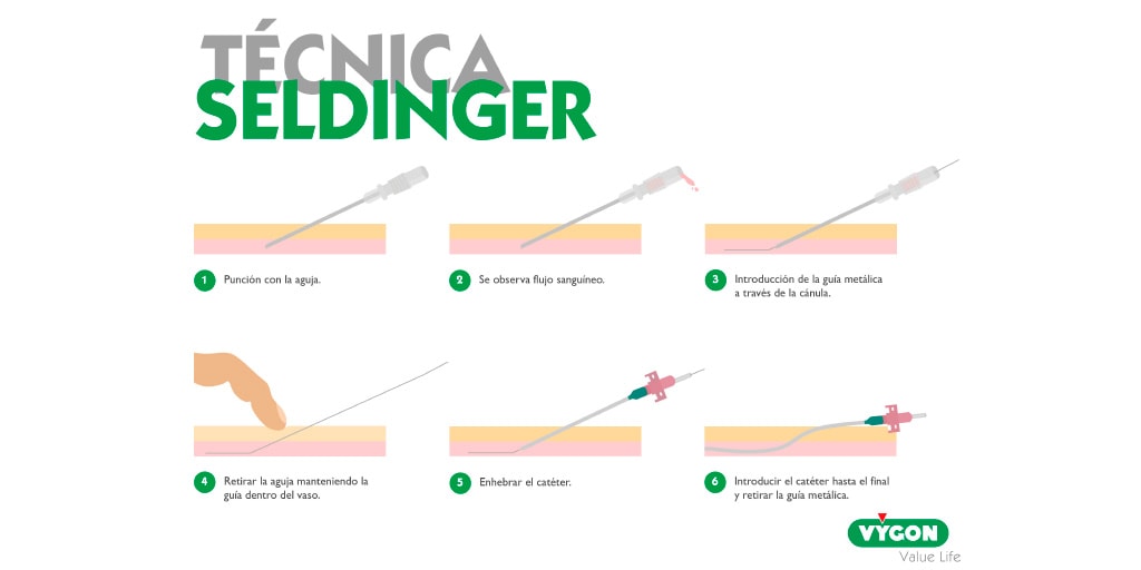 Técnica Seldinger - Campus Vygon Chile