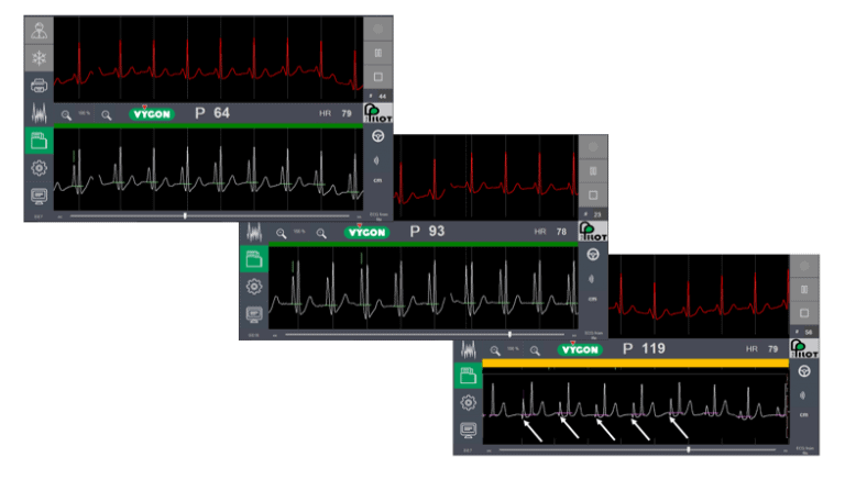 Catéter PICC: Colocación y comparativa de Pilot y Sherlock