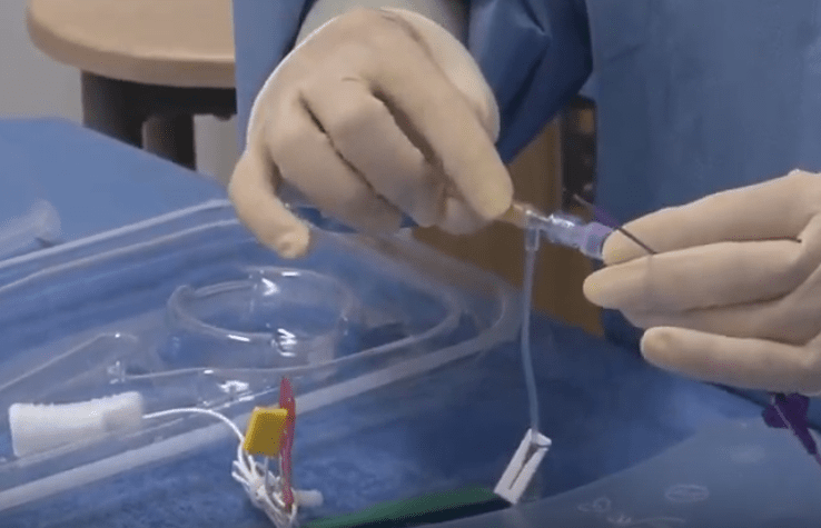 Catéter PICC: Colocación y comparativa de Pilot y Sherlock