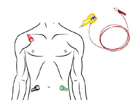 Catéter PICC: Colocación y comparativa de Pilot y Sherlock