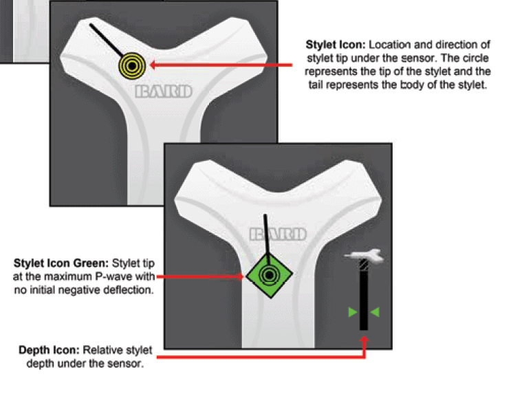 Catéter PICC: Colocación y comparativa de Pilot y Sherlock