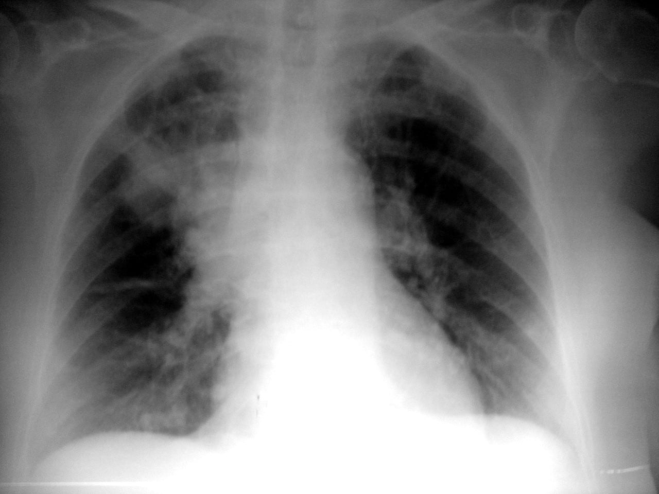 Cómo diagnosticar la infección pulmonar o neumonía asociada a la ...