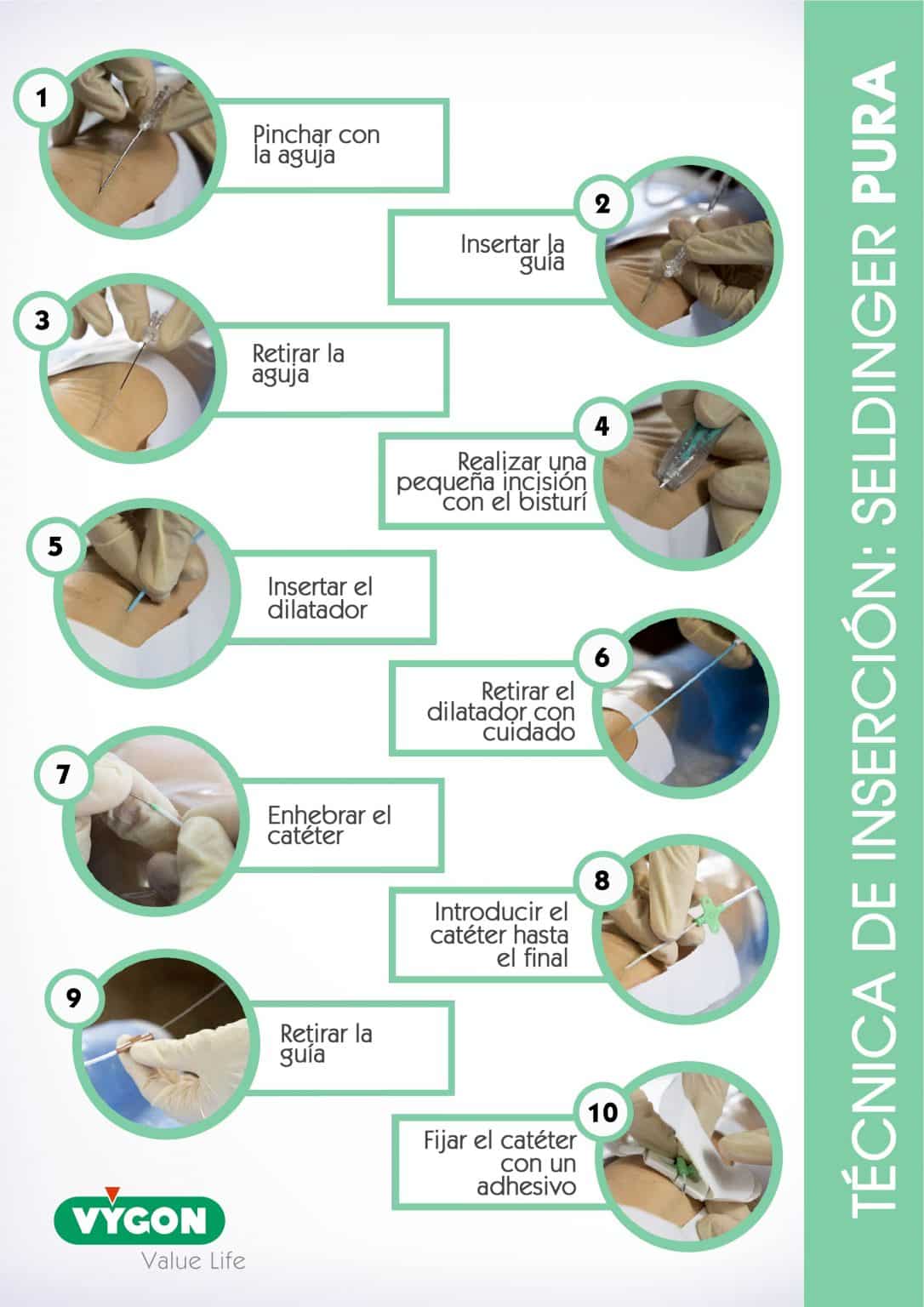 Técnicas Seldinger clásica y modificada: ¿qué diferencias existen?
