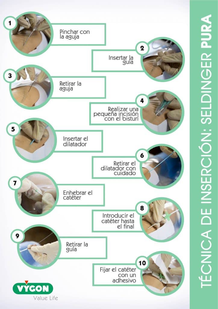 Técnicas Seldinger clásica y modificada: ¿qué diferencias existen?