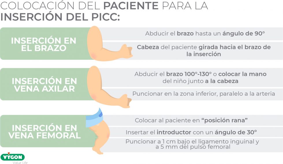 20 consejos sobre el PICC neonatal que debes conocer