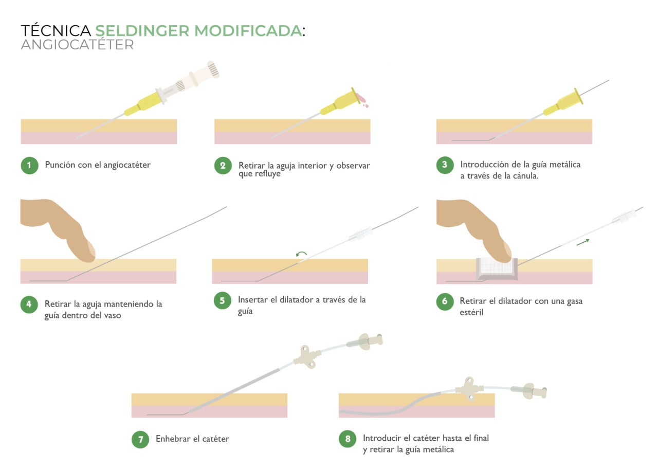 Canalización PICC neonatal Técnica Seldinger Modificada: Angiocatéter