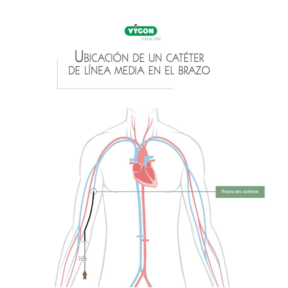 Tipos de catéter de línea media: Terminología y clasificación