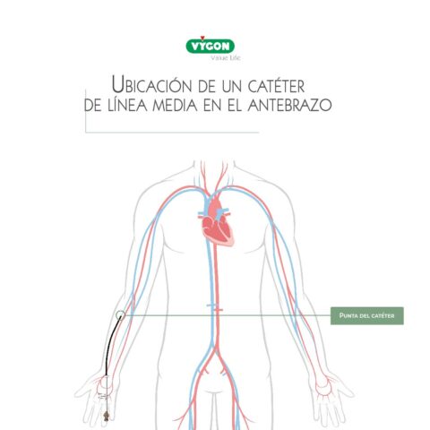 Tipos de catéter de línea media: Terminología y clasificación