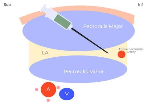 PECS I & II: un bloqueo fascial para proporcionar analgesia y reducir ...