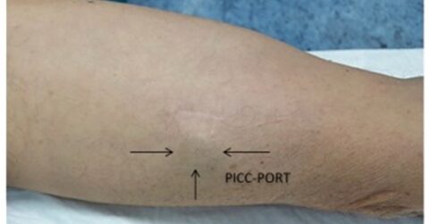Técnica y la estética en la colocación de PICC-ports