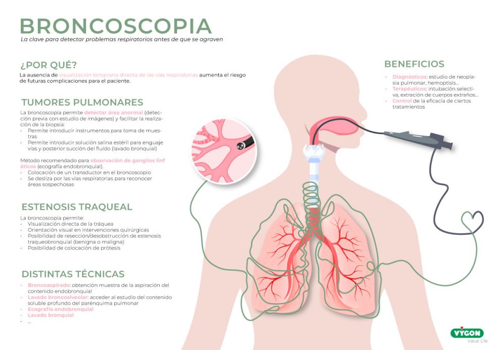 Broncoscopia: la clave para detectar problemas respiratorios antes de ...