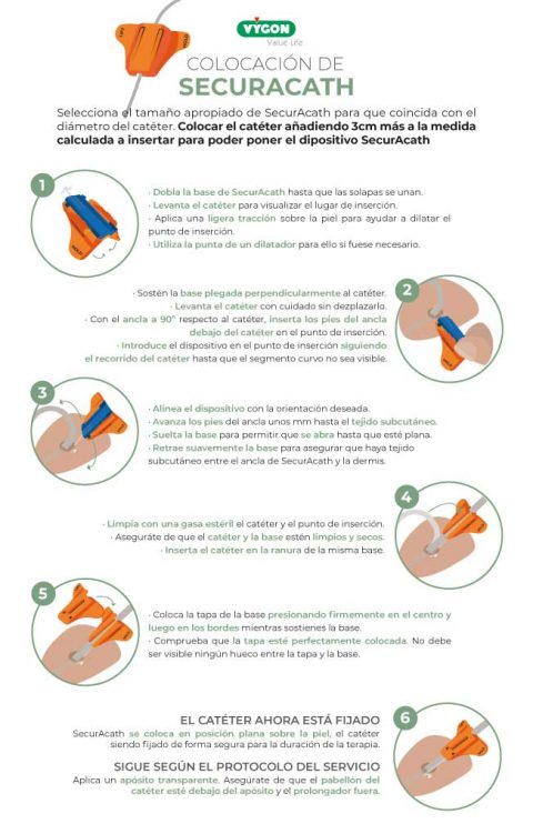 Colocación de SecurAcath - Campus Vygon España