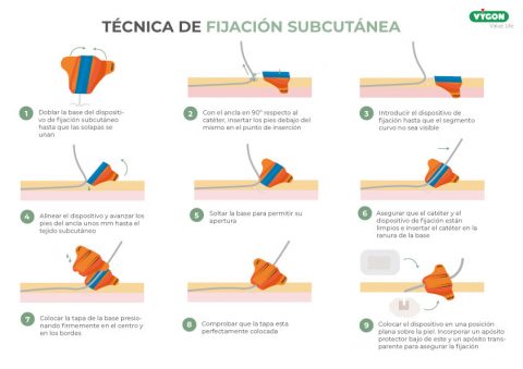 Técnica de fijación subcutánea - Campus Vygon España