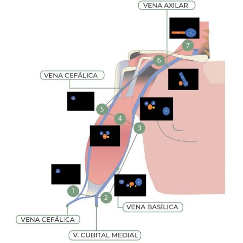 Protocolo SIP-Port para Inserción de PICC-Port