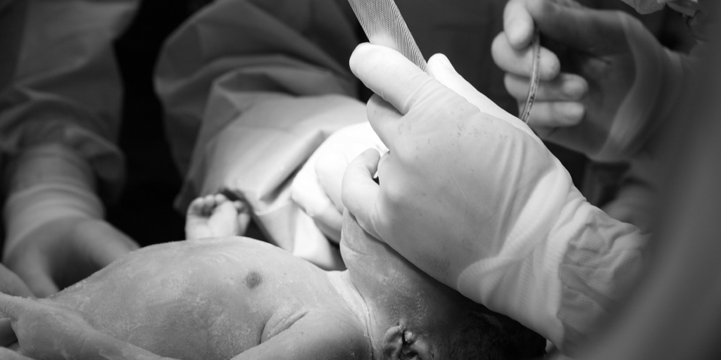 Intubación Endotraqueal En Neonatos