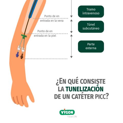 Tunelización de un catéter PICC - Campus Vygon España