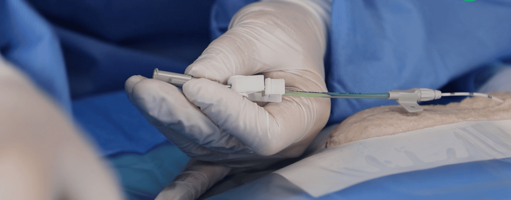 ¿Es importante la colocación correcta de la punta del catéter?