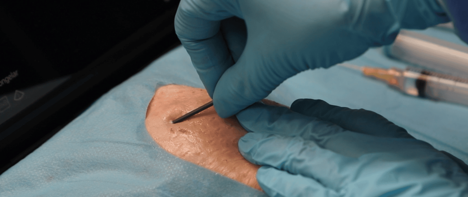 Seldinger con Midline vs Microseldinger con PICC