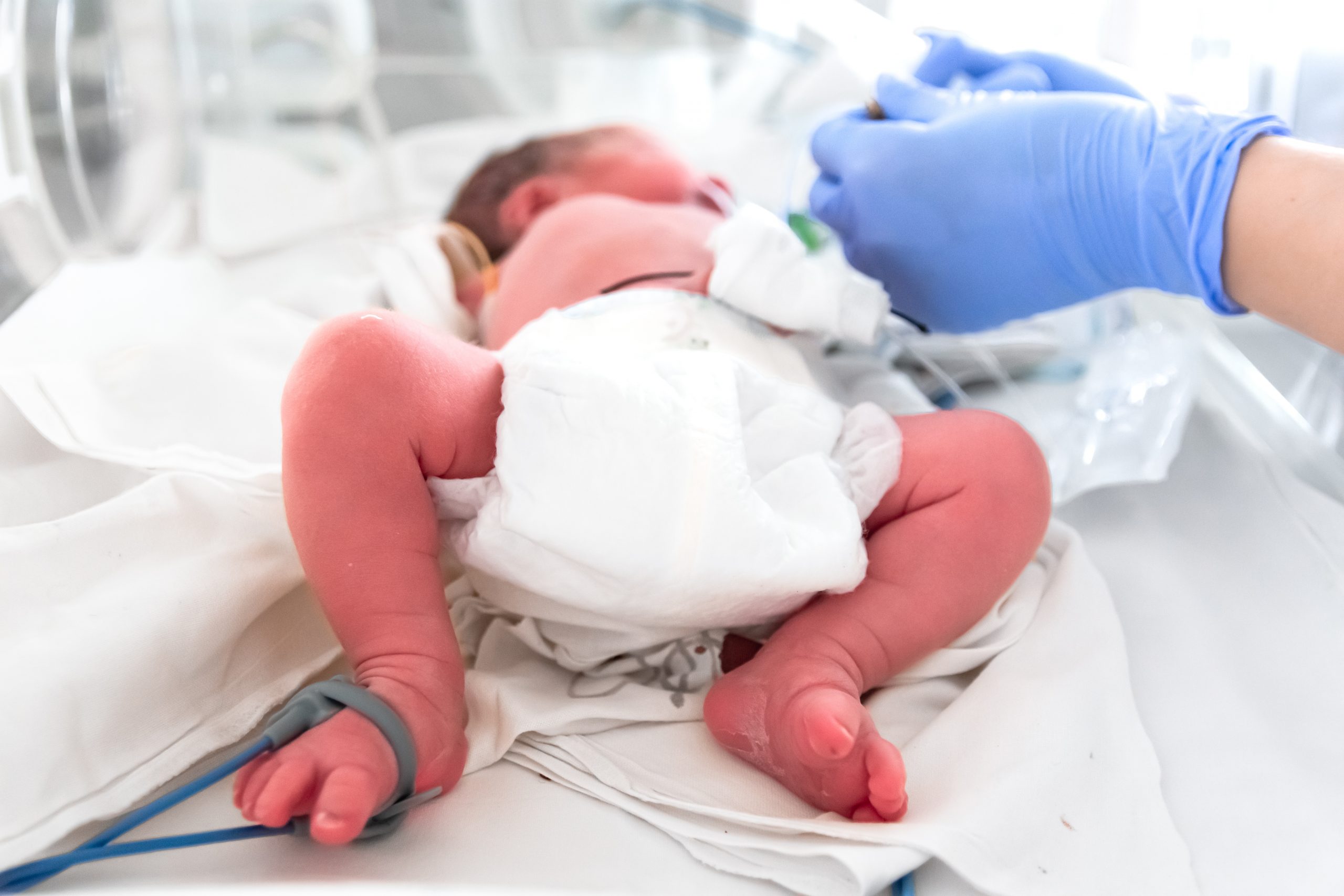 ¿Qué catéter elegir como acceso venoso en neonatos?