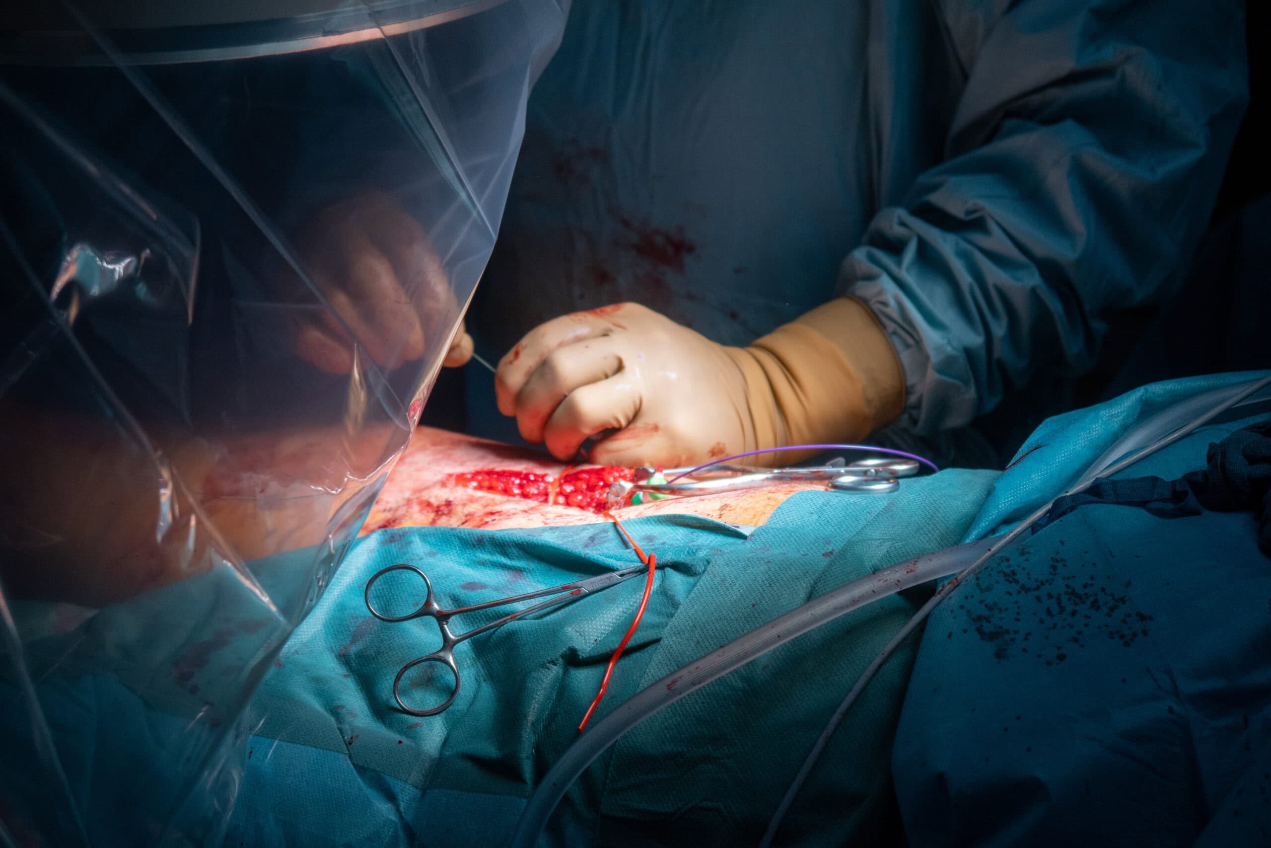 Método RaPeVa en ecografía: Valoración venosa