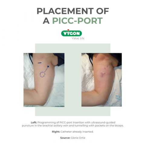 6 measures to ensure the proper functioning of a PICC-port - Campus ...