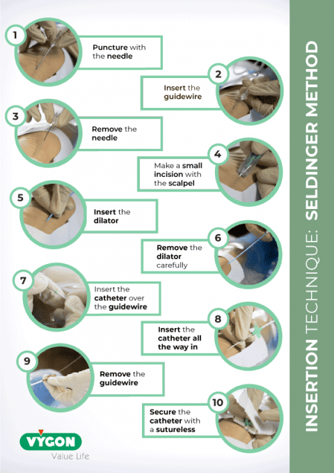 Midline catheter: placement and maintenance protocol - Campus Vygon Global