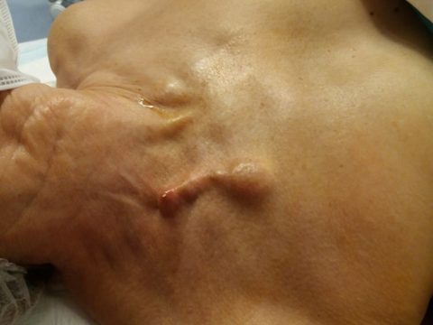 Combining aesthetics and feasibility in chest port placement - Campus ...