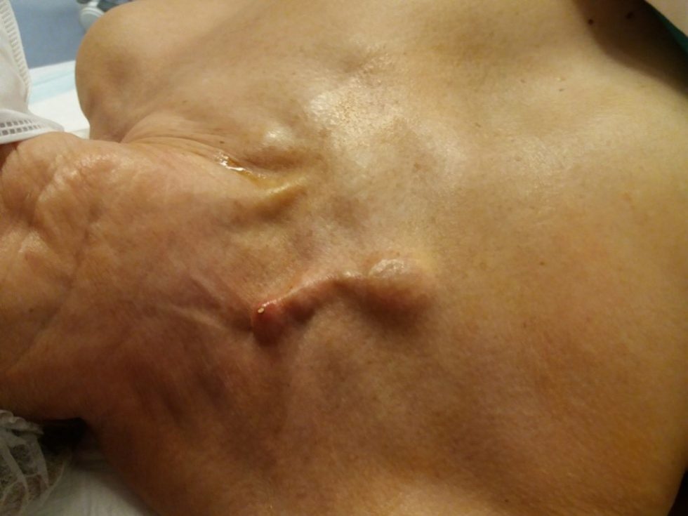 Combining aesthetics and feasibility in chest port placement - Campus ...