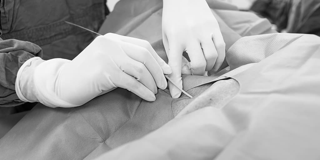 What is the ideal length for my central venous catheter? - Campus Vygon ...