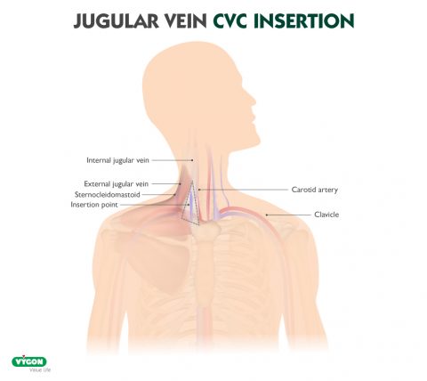 What is the ideal length for my central venous catheter? - Campus Vygon ...
