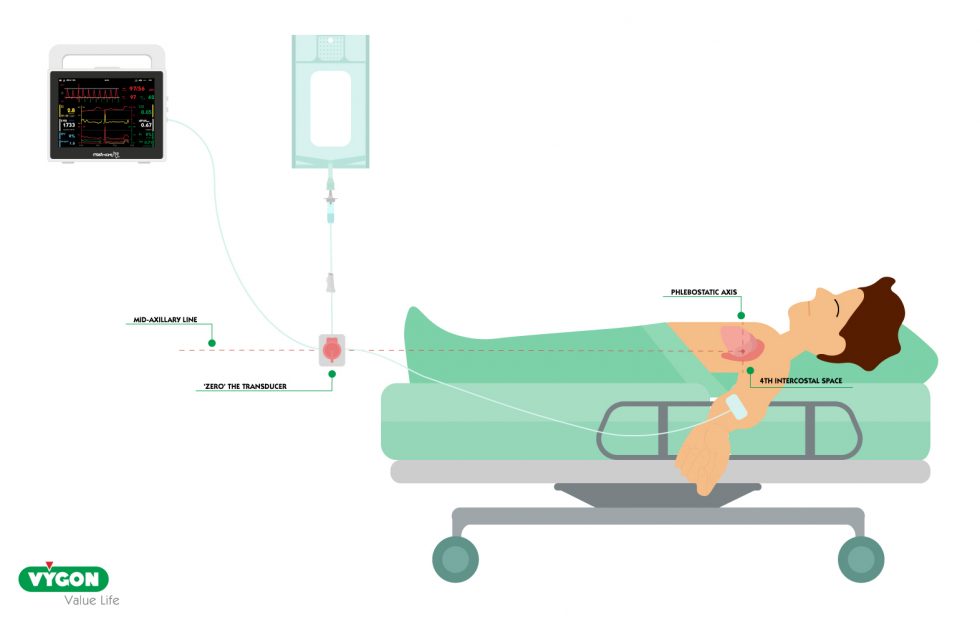 Ultrasound-guided arterial cannulation in 6 steps - Campus Vygon Global