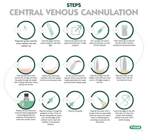 Central venous cannulation in 14 steps - Campus Vygon Global