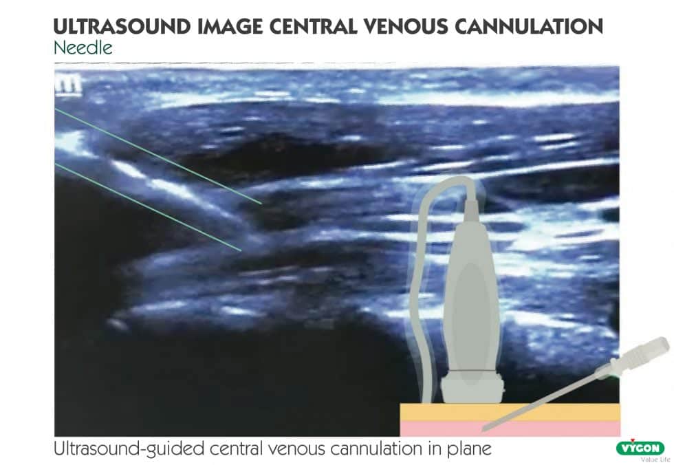 Central venous cannulation in 14 steps - Campus Vygon Global