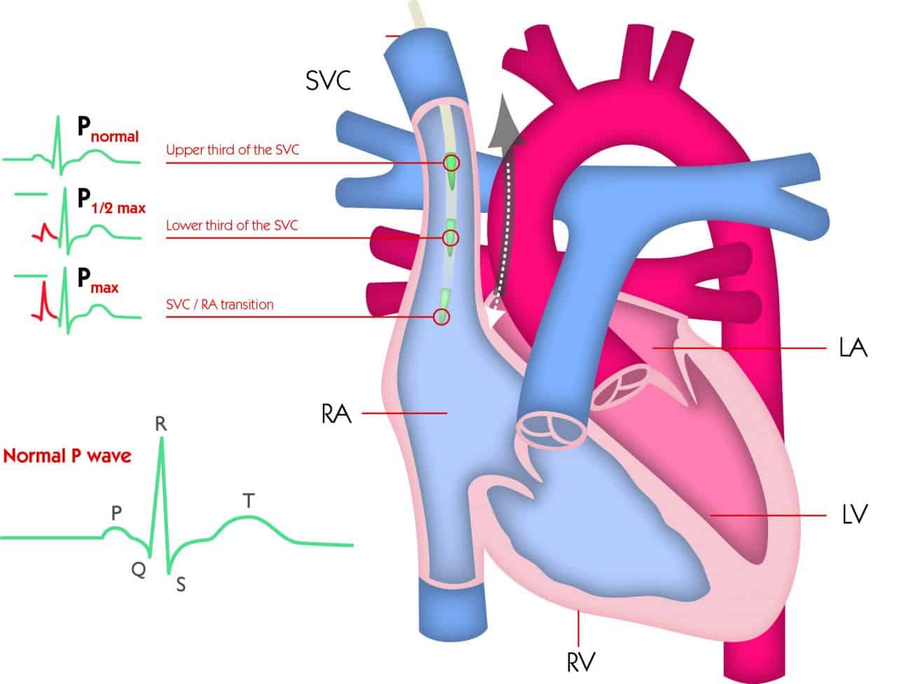 ECG-Guided Central Venous Catheter (CVC) Tip Placement: A Safer, Faster ...