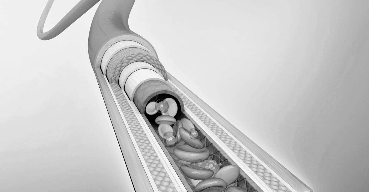 Mastering Arterial Line Placement Guide - Campus Vygon UK