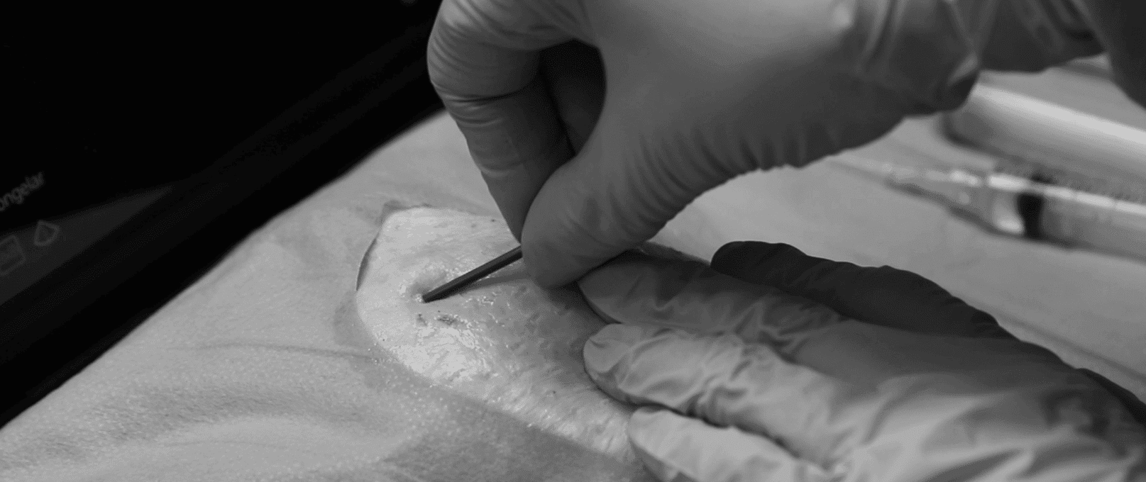 Vascular Access - Campus Vygon UK