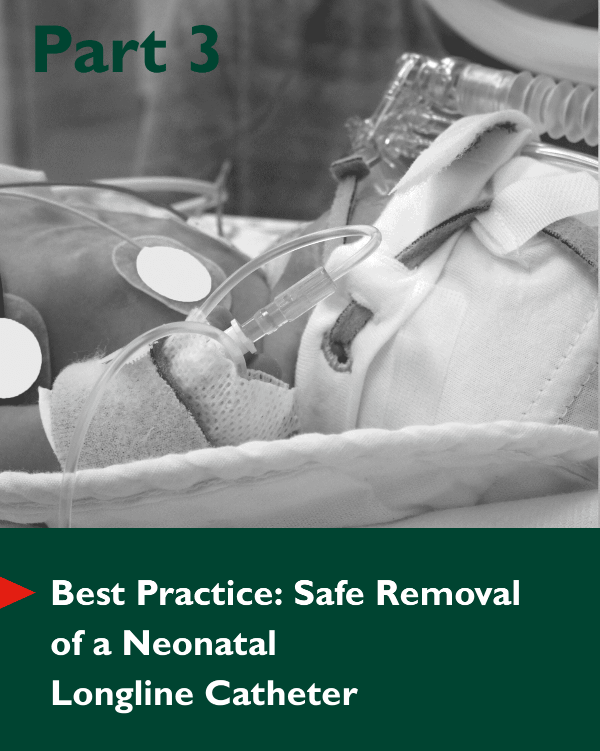Article 3: Safe Removal of a Longline Catheter in Neonates: Best ...