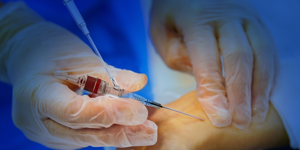 ¿Por qué se amortigua un catéter arterial?