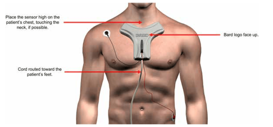 Colocación de catéteres PICC: Comparativa de Pilot y Sherlock