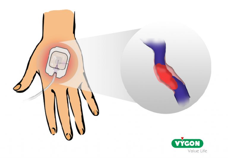 La flebitis. ¿Un efecto adverso inevitable?