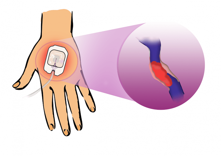 La flebitis. ¿Un efecto adverso inevitable?