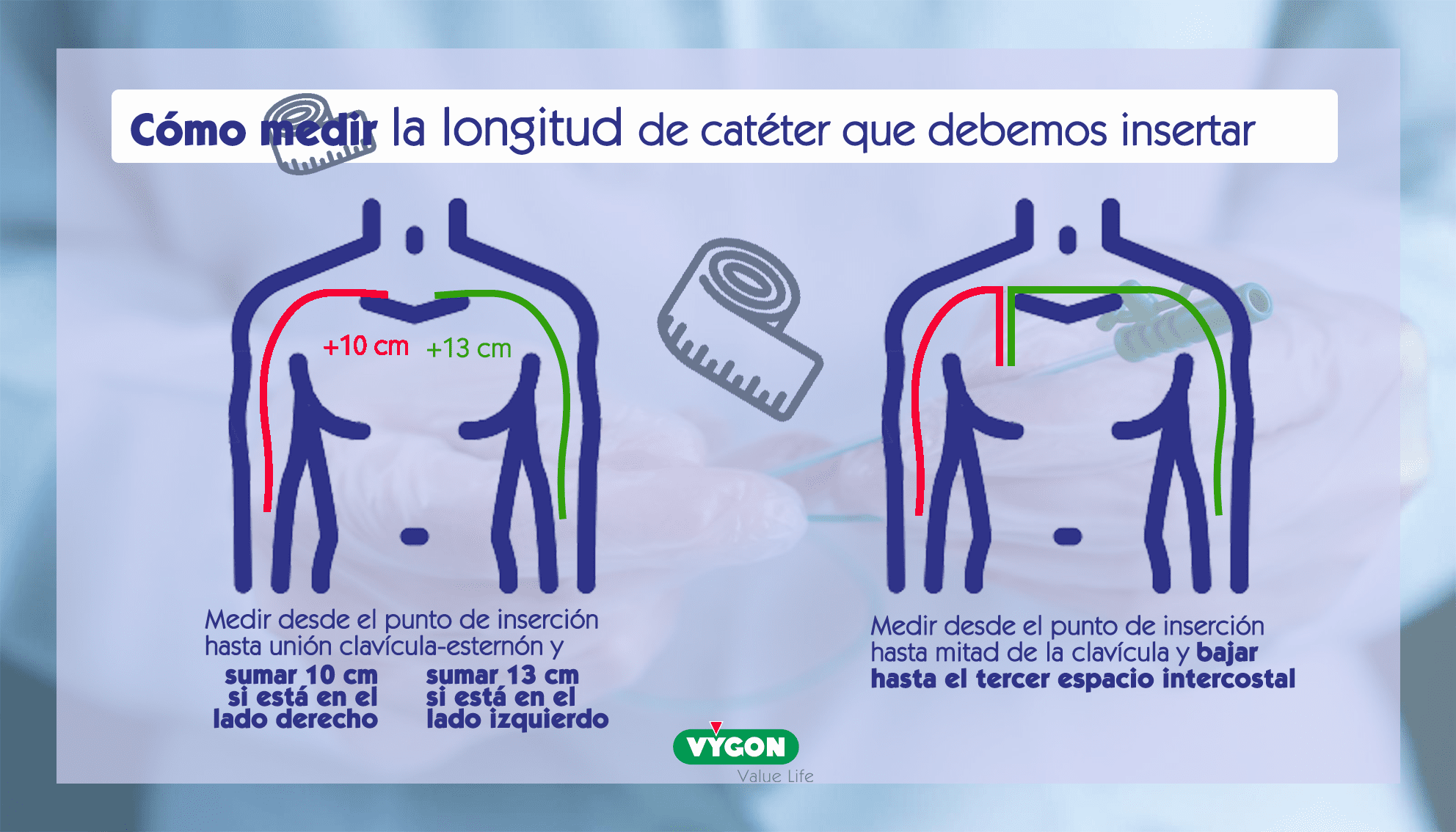 PICC con corte distal o proximal: ¿cómo ajustar lo mejor posible la ...