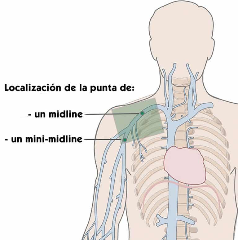 ¿Cómo usar el catéter midline? Protocolo de colocación y mantenimiento ...