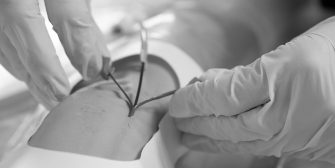 ¿Cómo usar el catéter PICC?: Protocolo de colocación y mantenimiento