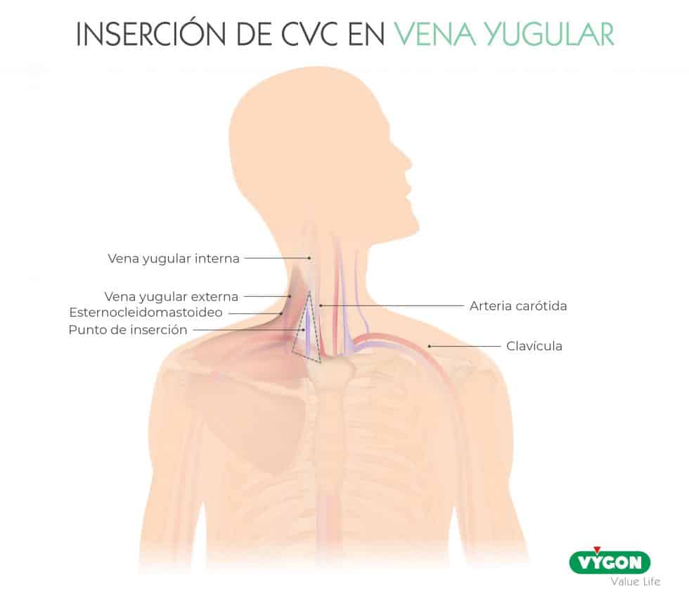 ¿Cuál es la longitud ideal para mi catéter venoso central? - Campus Vygon
