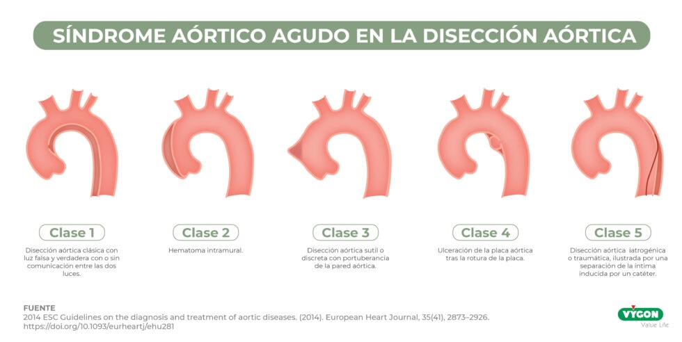 Monitorización hemodinámica en la cirugía de aorta ascendente y arco ...