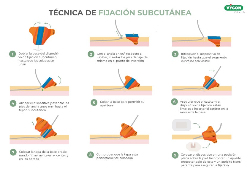 Técnica de fijación subcutánea - Campus Vygon